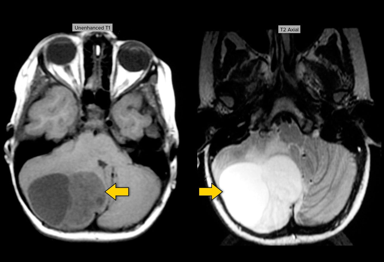 Pediatric Brain Tumors: Imaging Matters