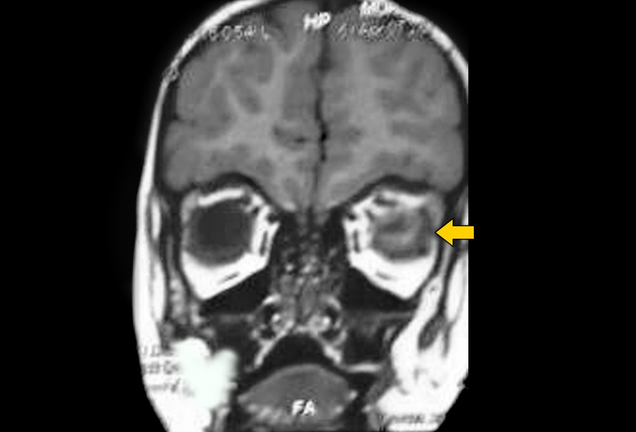 Pediatric Brain Tumors: Imaging Matters