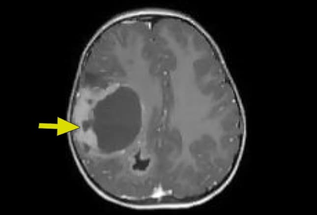 Pediatric Brain Tumors: Imaging Matters