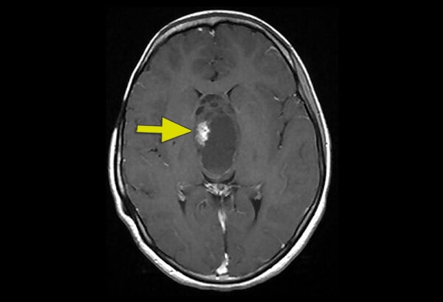 Pediatric Brain Tumors: Imaging Matters