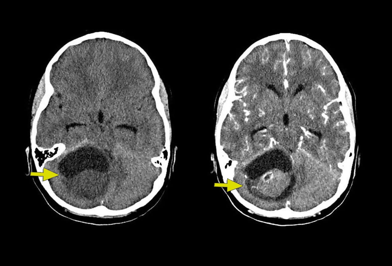 Pediatric Brain Tumors: Imaging Matters