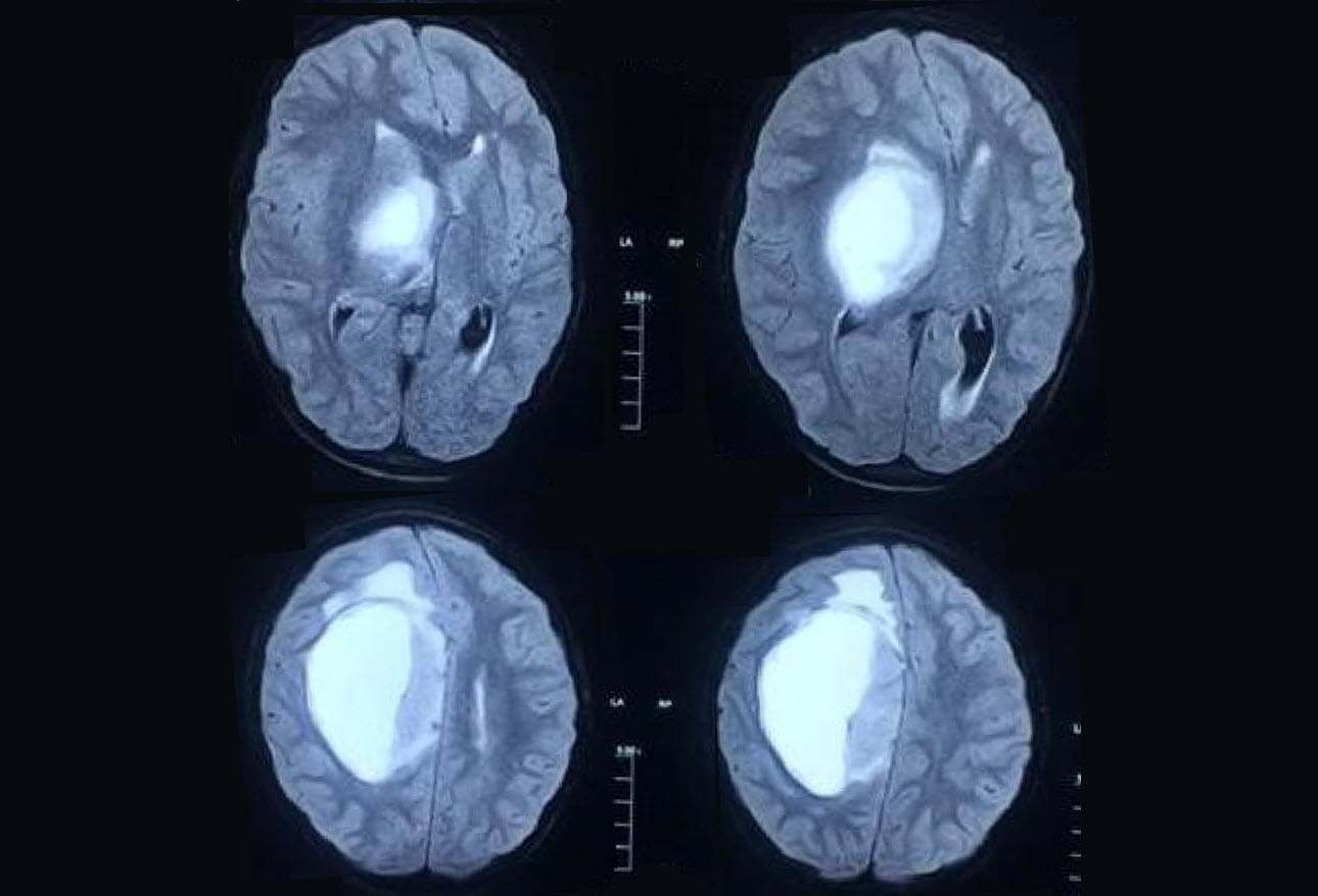 Pediatric Brain Tumors: Imaging Matters