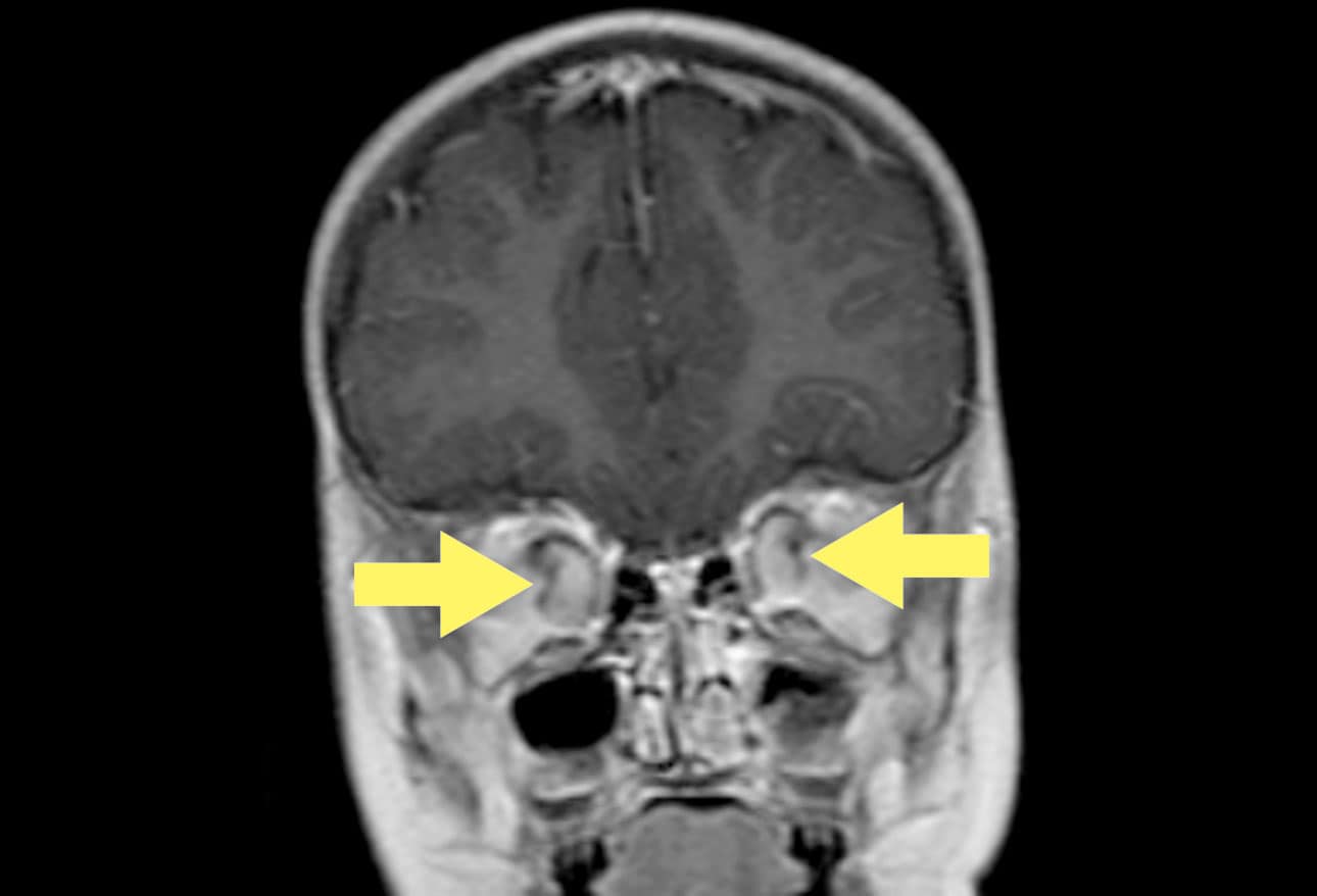 Pediatric Brain Tumors: Imaging Matters