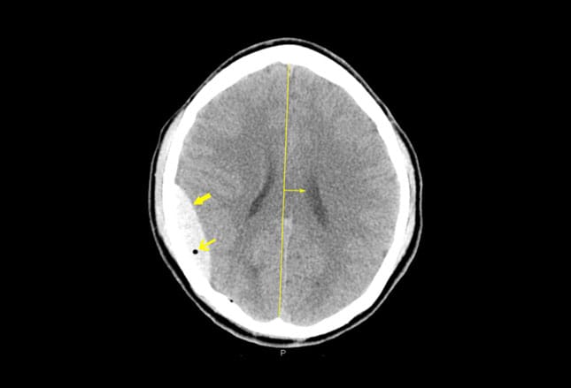 Pediatric Concussion and Other Traumatic Brain Injuries