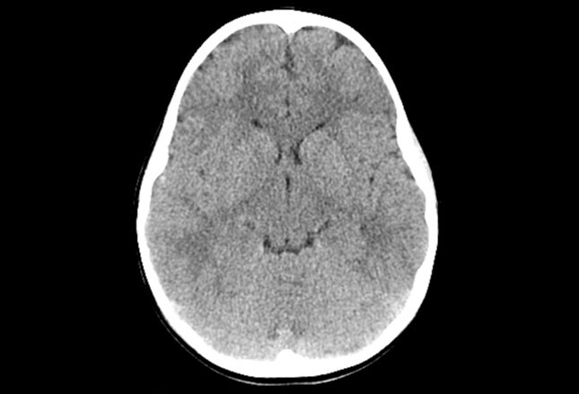 Pediatric Concussion and Other Traumatic Brain Injuries