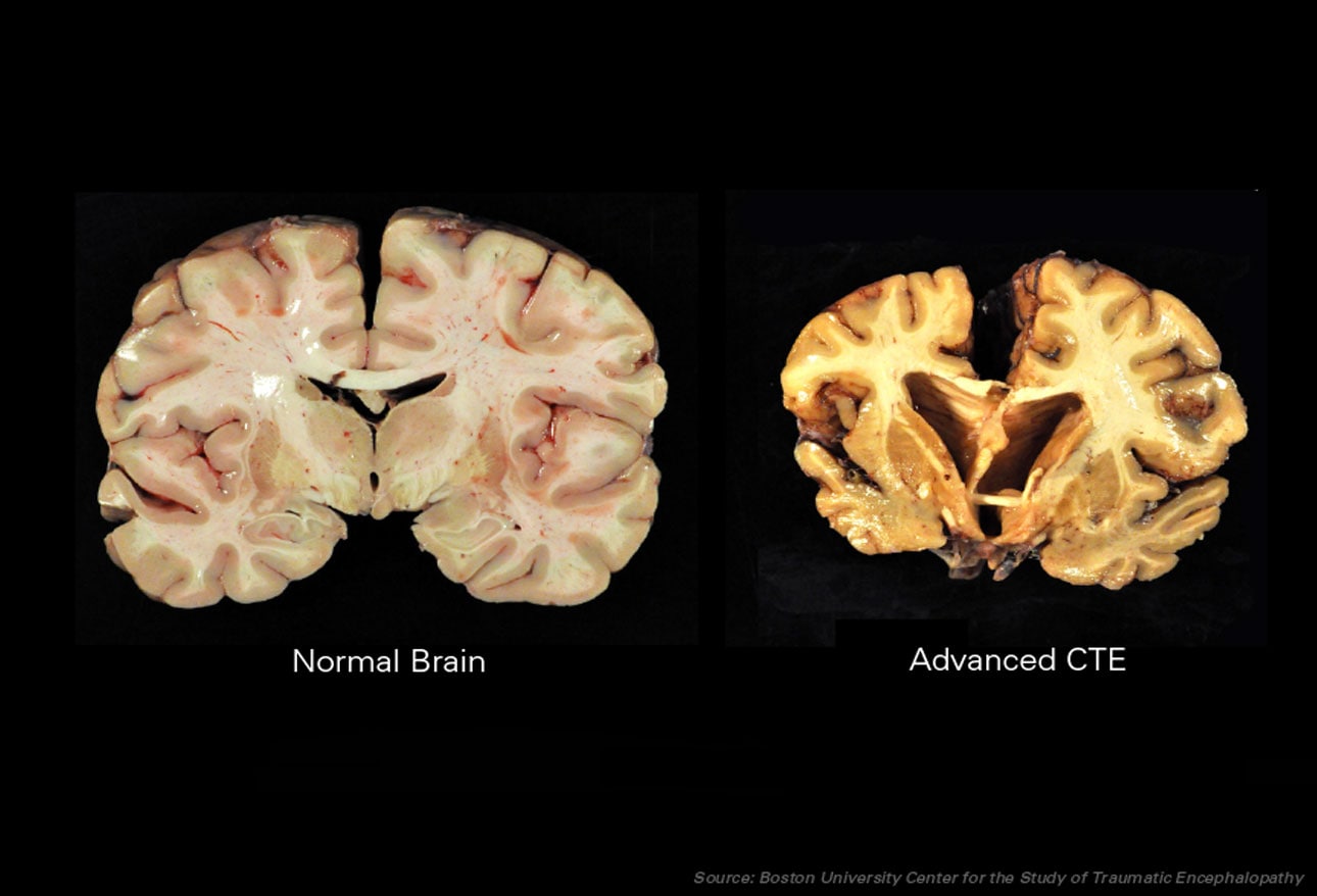 Pediatric Concussion and Other Traumatic Brain Injuries