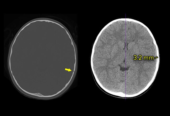 Pediatric Concussion and Other Traumatic Brain Injuries