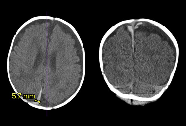 Pediatric Concussion and Other Traumatic Brain Injuries
