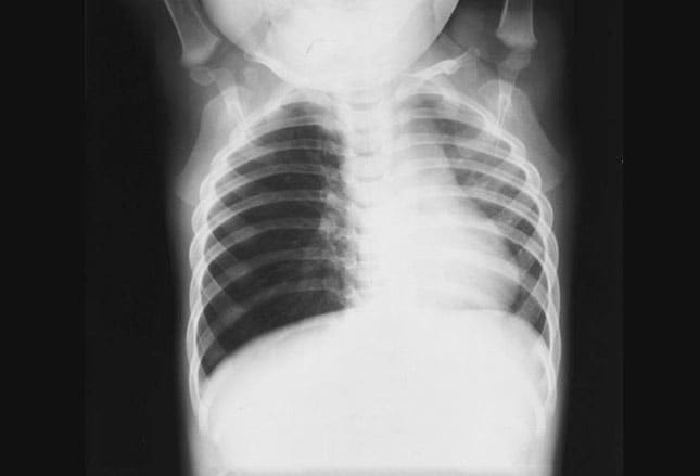 16 Can’t-Miss Findings on Pediatric Imaging Studies