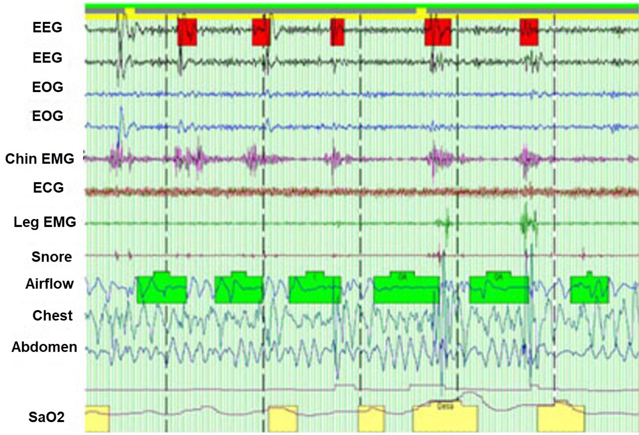 When Distress is Failure: Pediatric Respiratory Illness