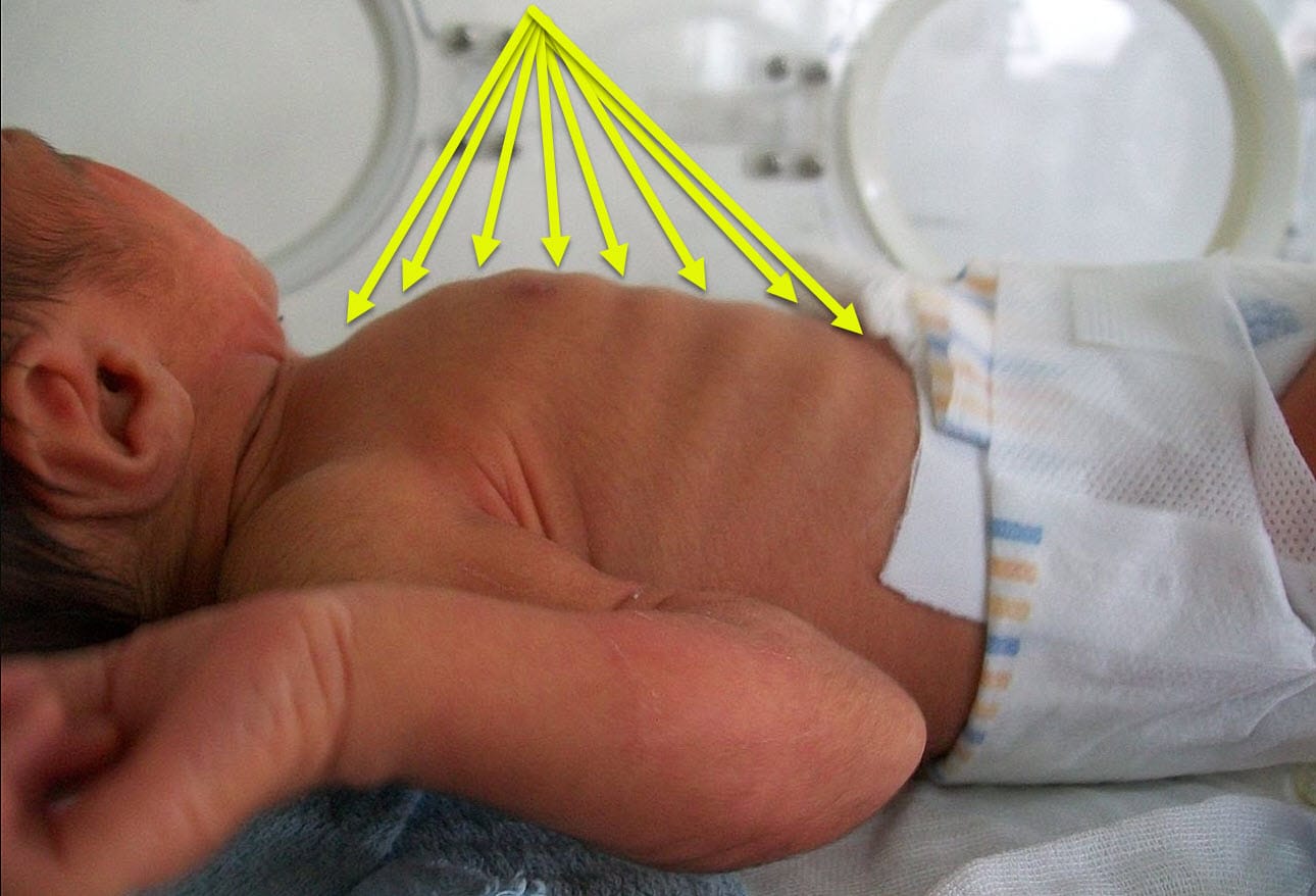 When Distress is Failure: Pediatric Respiratory Illness