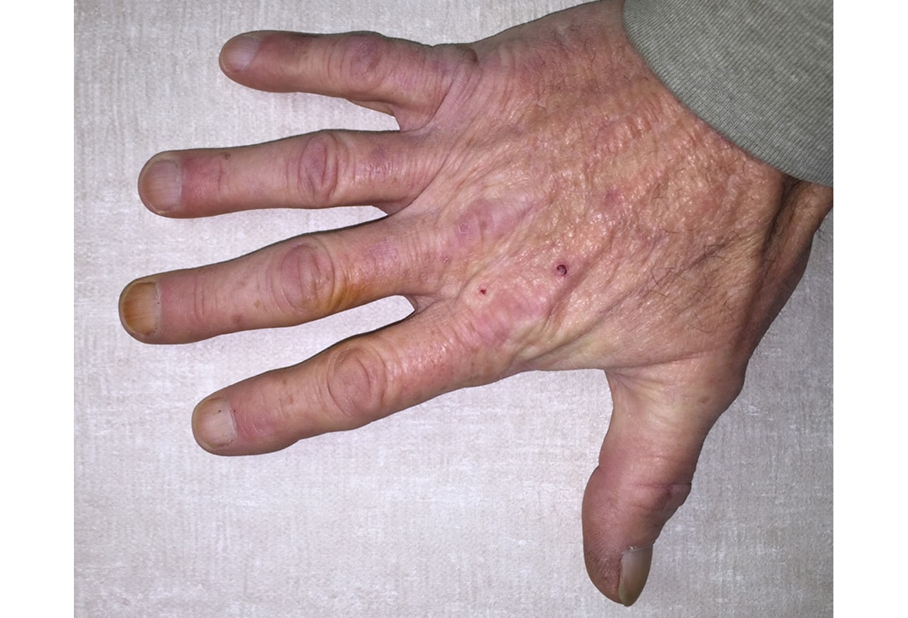 Peripheral Arterial Disease: Getting the Patient Back in Circulation