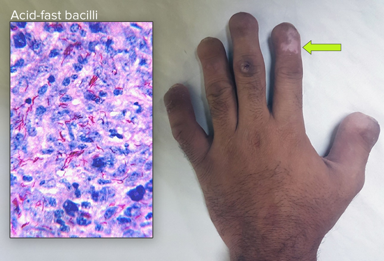 Peripheral Neuropathy: More Than a (Loss of) Feeling