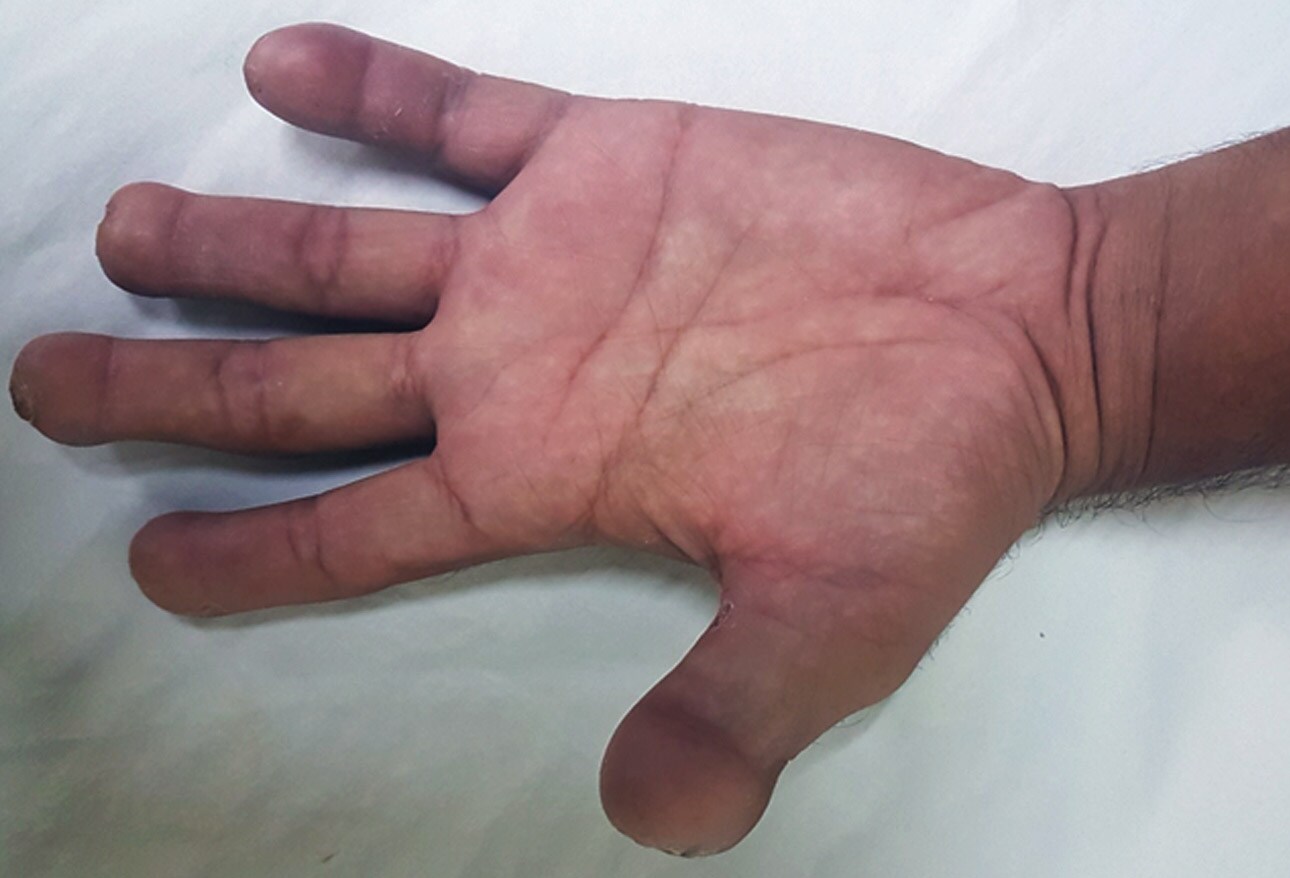 Peripheral Neuropathy: More Than a (Loss of) Feeling