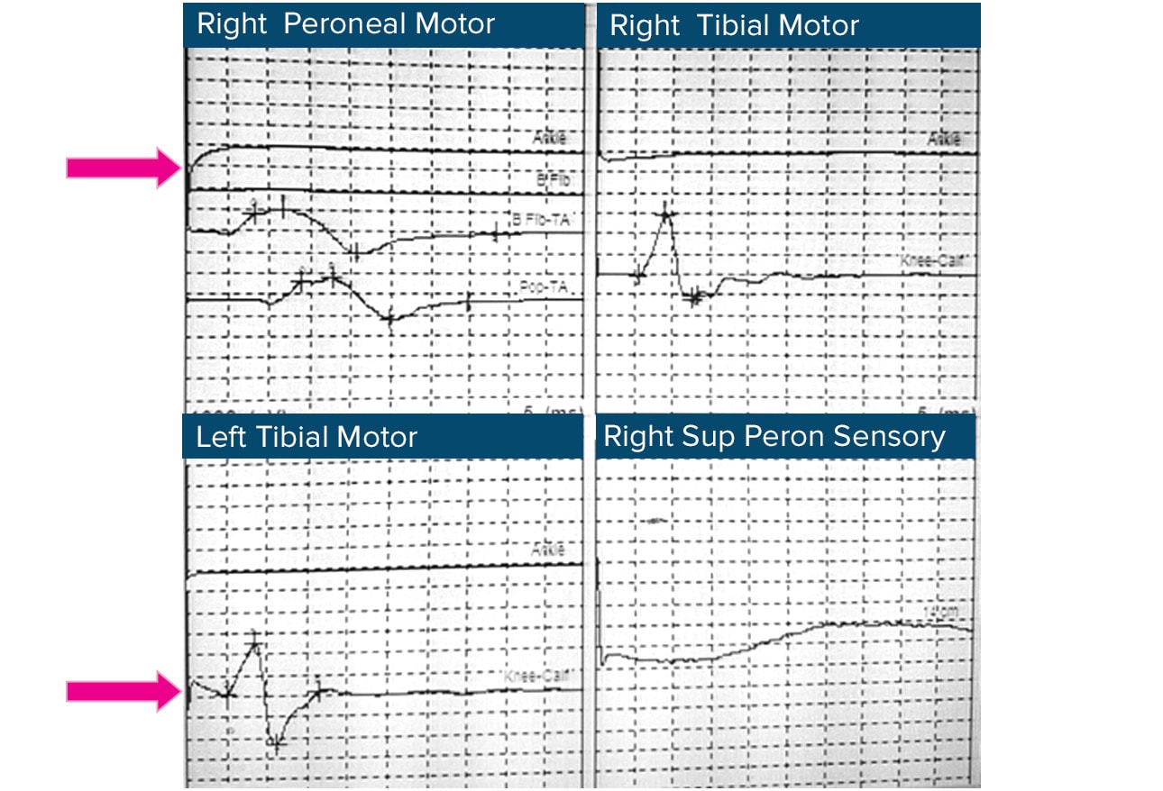 Peripheral Neuropathy: More Than a (Loss of) Feeling