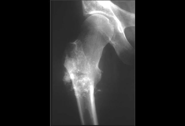 Osteosarcoma, Chondrosarcoma, and Ewing Sarcoma: Bred in the Bone