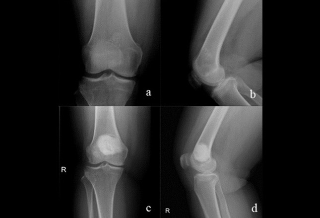 Osteosarcoma, Chondrosarcoma, and Ewing Sarcoma: Bred in the Bone