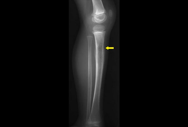 Osteosarcoma, Chondrosarcoma, and Ewing Sarcoma: Bred in the Bone
