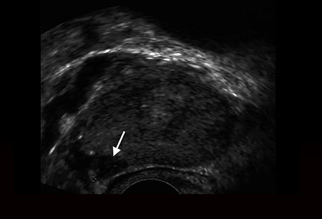 Prostate Cancer: Diagnosis and Staging