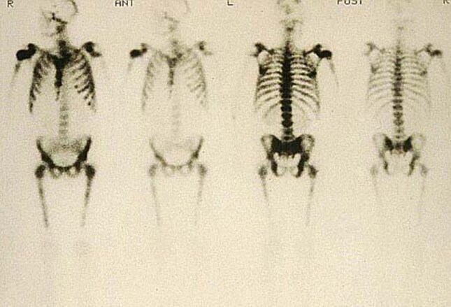 Prostate Cancer: Diagnosis and Staging