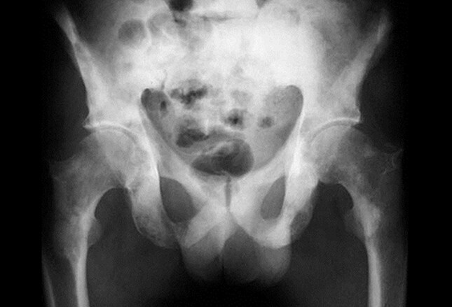 Prostate Cancer: Diagnosis and Staging