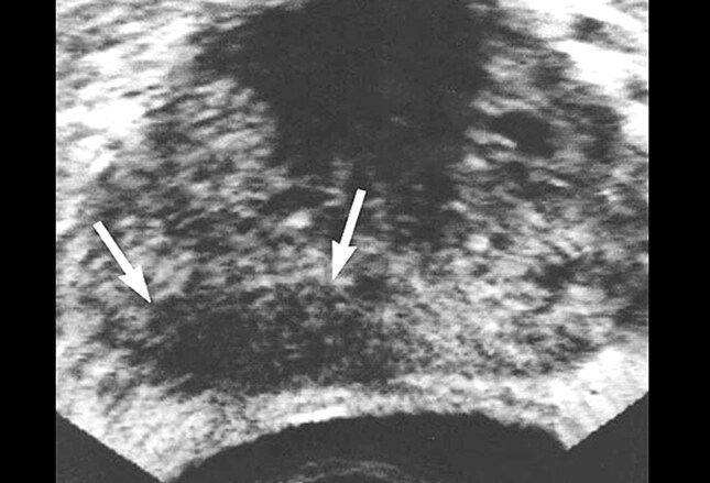 Prostate Cancer: Diagnosis and Staging