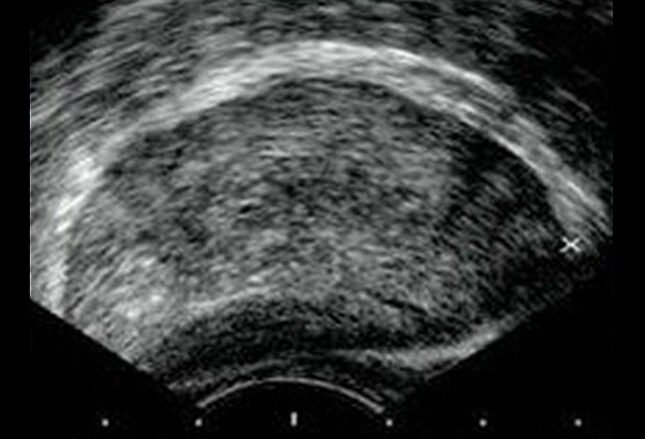 Prostate Cancer: Diagnosis and Staging