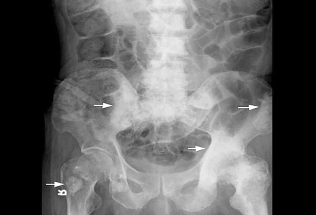 Prostate Cancer: Diagnosis and Staging