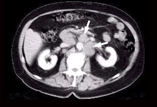 Prostate Cancer: Diagnosis and Staging