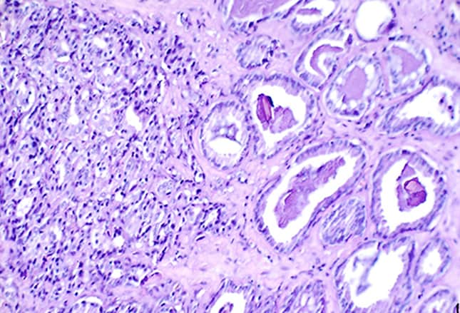 Prostate Cancer: Diagnosis and Staging