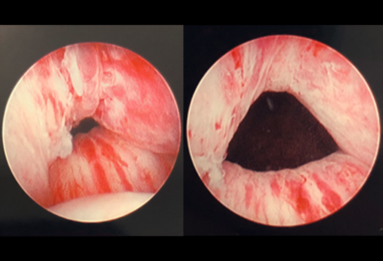 Benign Prostatic Hyperplasia: Evaluation and Treatment
