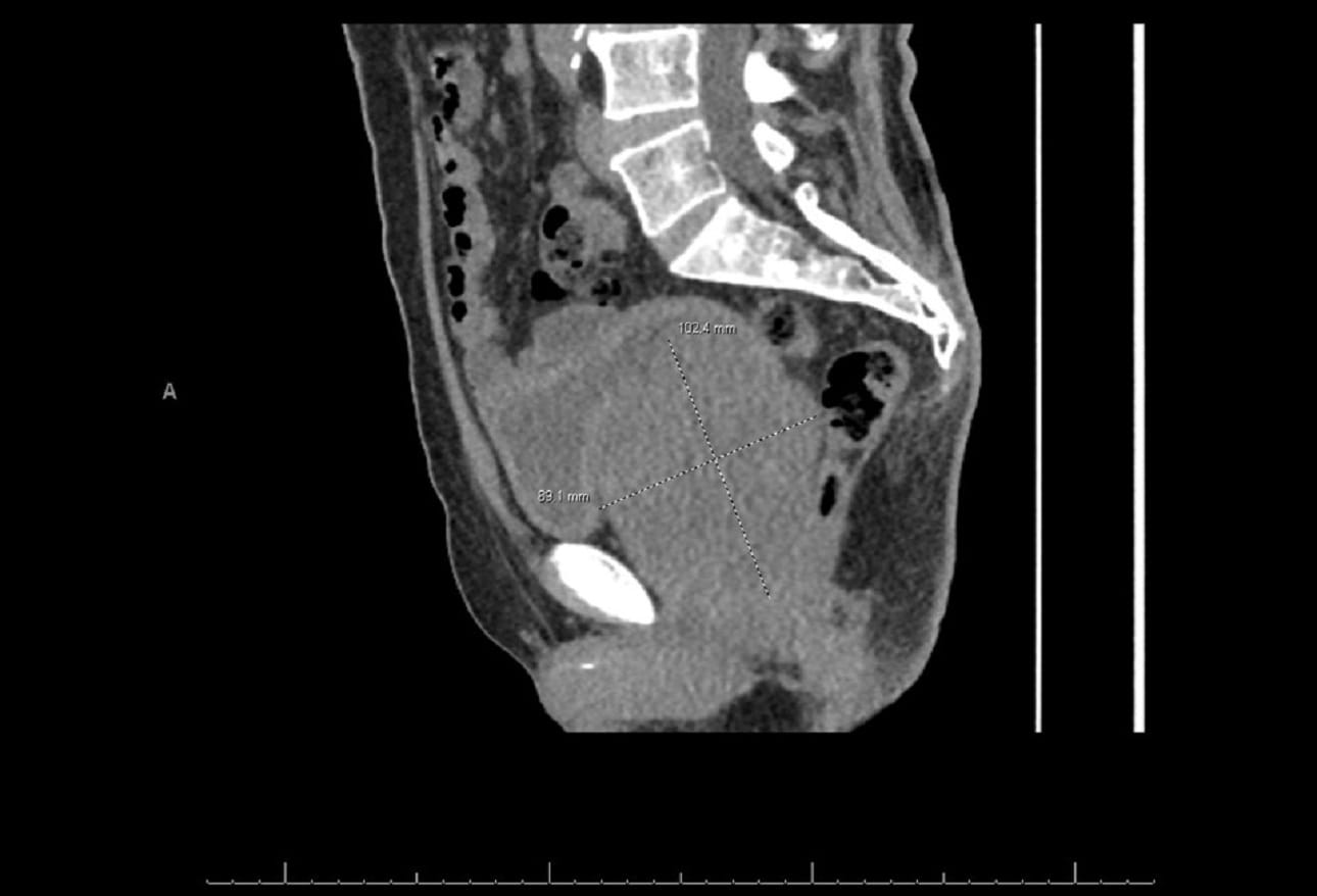 Benign Prostatic Hyperplasia: Evaluation and Treatment