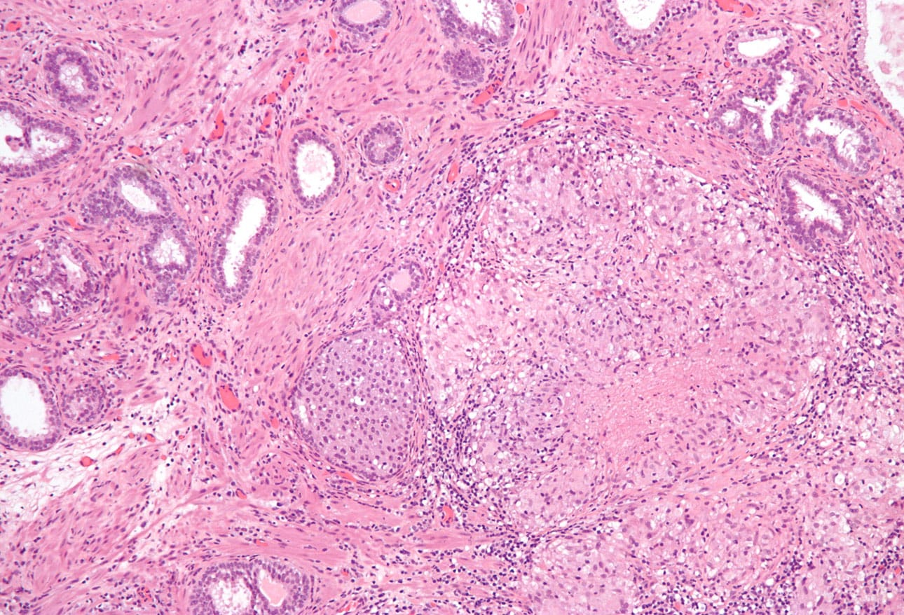 Prostatitis: An Inflammatory Story