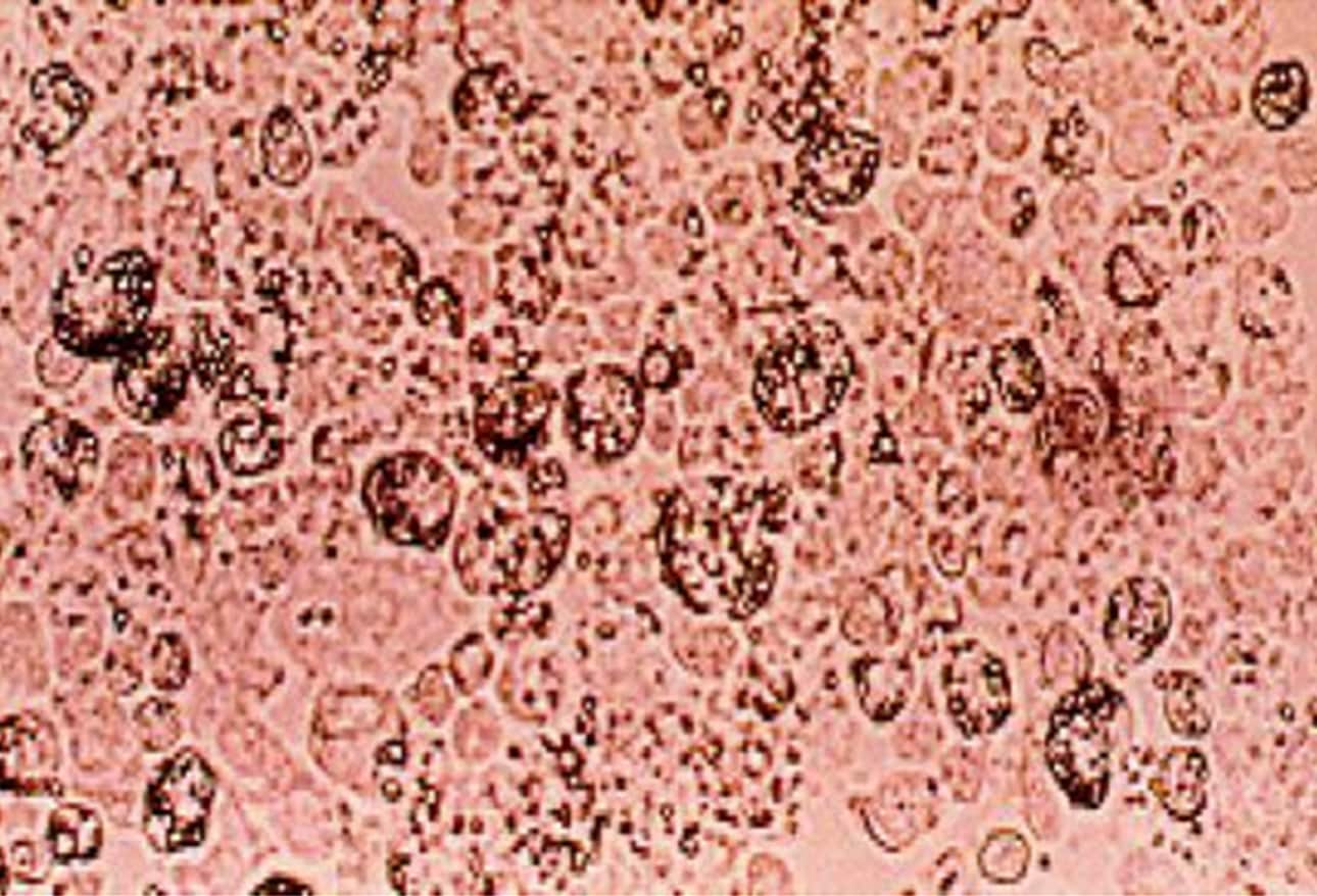 Prostatitis: An Inflammatory Story