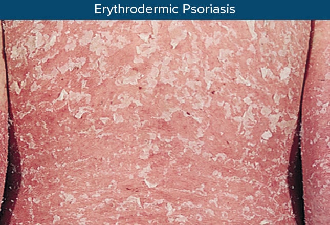 Psoriasis: Presentation, Imitators, and Treatment