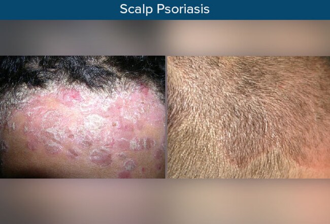 #Psoriasis: Manifestations, Management Options, and Mimics ...