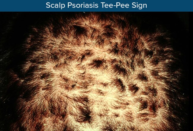 #Psoriasis: Manifestations, Management Options, and Mimics ...