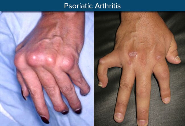 #Psoriasis: Manifestations, Management Options, and Mimics ...