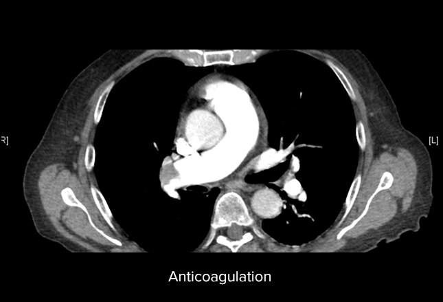 Pulmonary Embolism: Clot in Transit