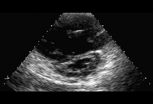 Pulmonary Embolism: Clot in Transit