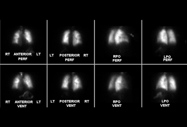 Pulmonary Embolism: Clot in Transit