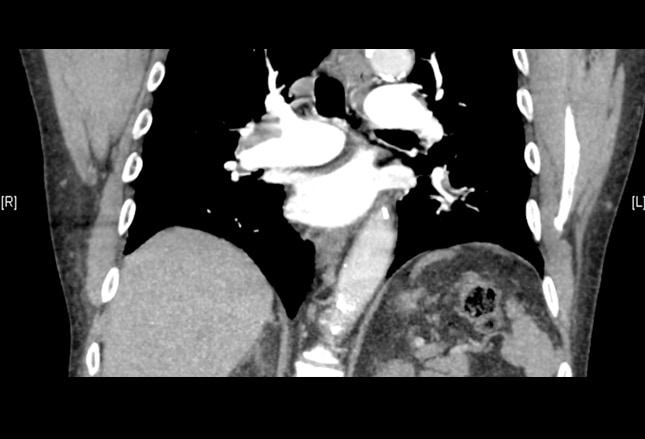 Pulmonary Embolism: Clot in Transit