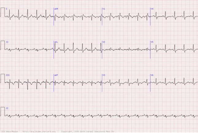 Pulmonary Embolism: Clot in Transit