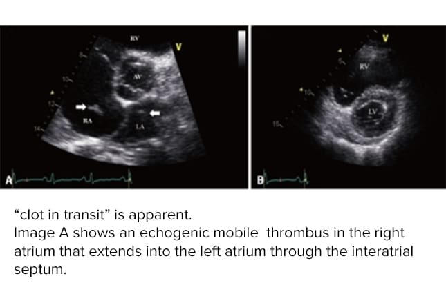 Pulmonary Embolism: Clot in Transit