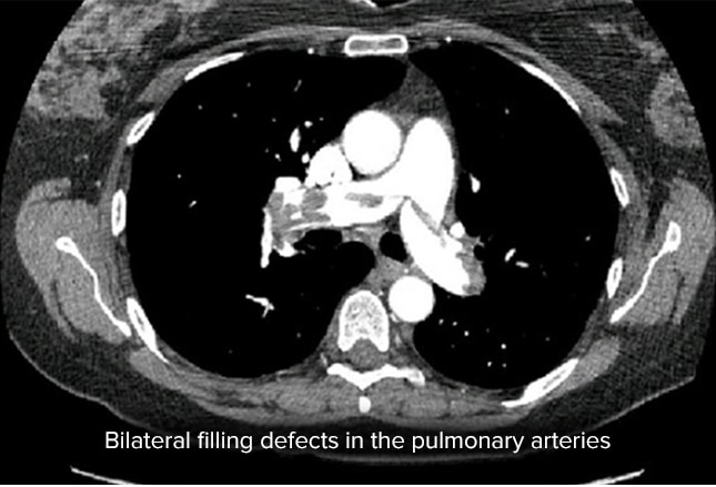 Pulmonary Embolism: Clot in Transit