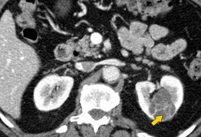 Recognizing Renal Cell Carcinoma