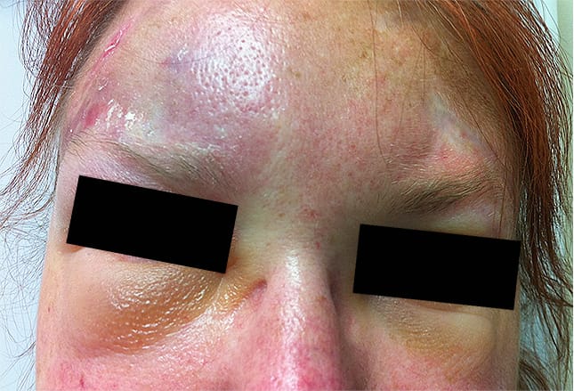 Diagnosing and Treating Rheumatic Skin Disorders