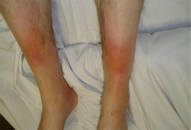 Diagnosing and Treating Rheumatic Skin Disorders