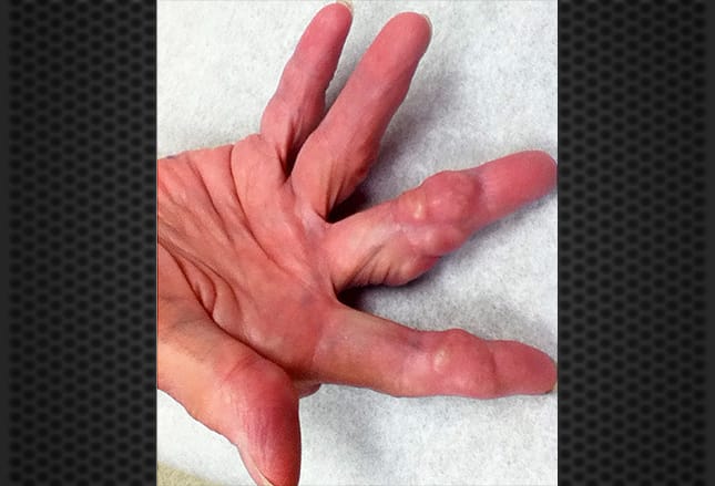 Diagnosing and Treating Rheumatic Skin Disorders