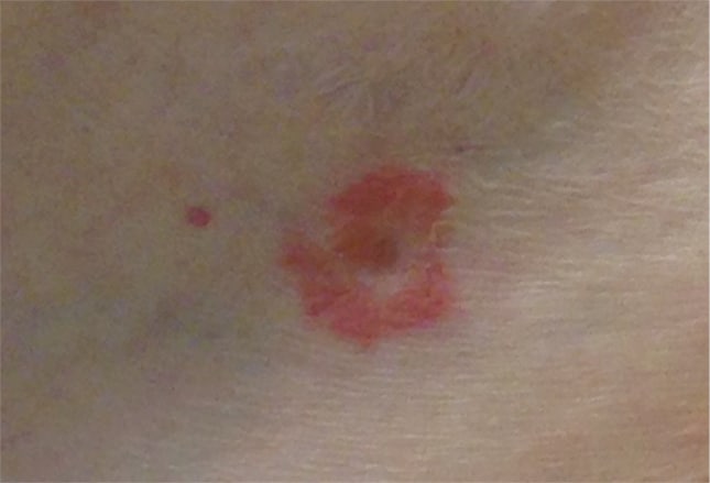 Diagnosing and Treating Rheumatic Skin Disorders